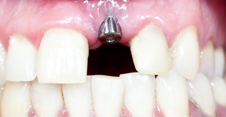 Tooth Replacement in the Esthetic Zone | Dental Implants